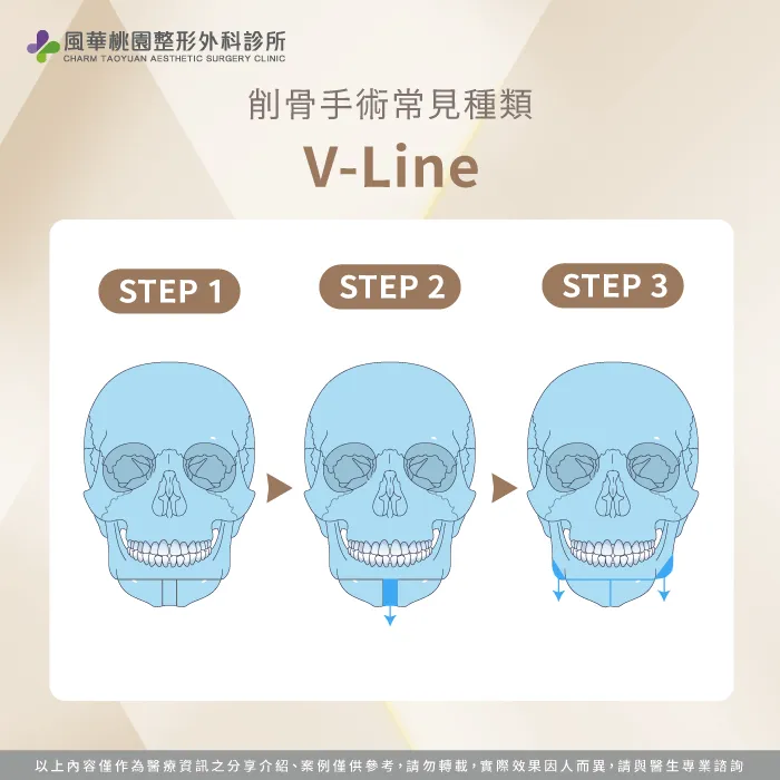 削骨是什麼?3大方向帶你輕鬆了解-風華整形外科診所